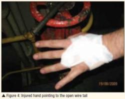 201055 Injury to hand