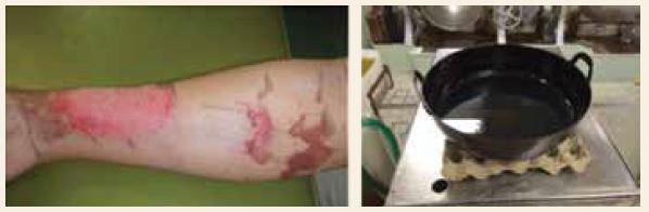 201556 Hot oil splatter danger